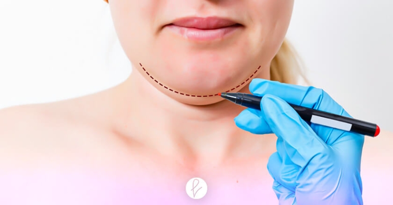 Lipopapada: elimina la grasa localizada - Clínica Saint Paul