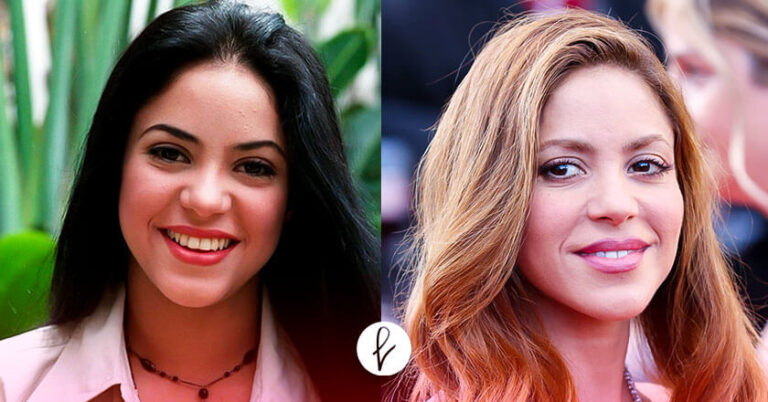¿Cuántas y Cuáles Cirugías Estéticas Se Realizó Shakira?